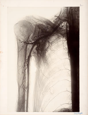 Stereo skiagram of he side of the thorax and arm, including axillary ...