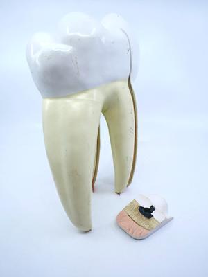 Plastic large model of a molar with removable pulp and tooth inserts ...