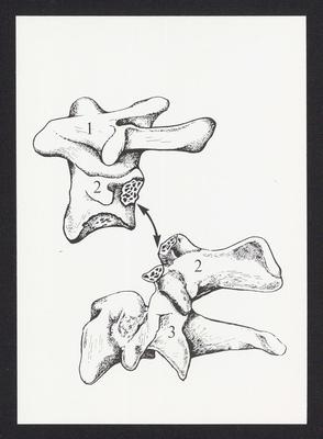 Vicary Lecture Illustrations: "Figure 5. Judicial hanging, modern ...