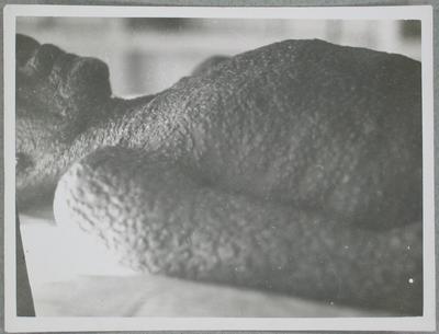 Smallpox victim - Faculty of Medicine, Dentistry and Health Sciences ...