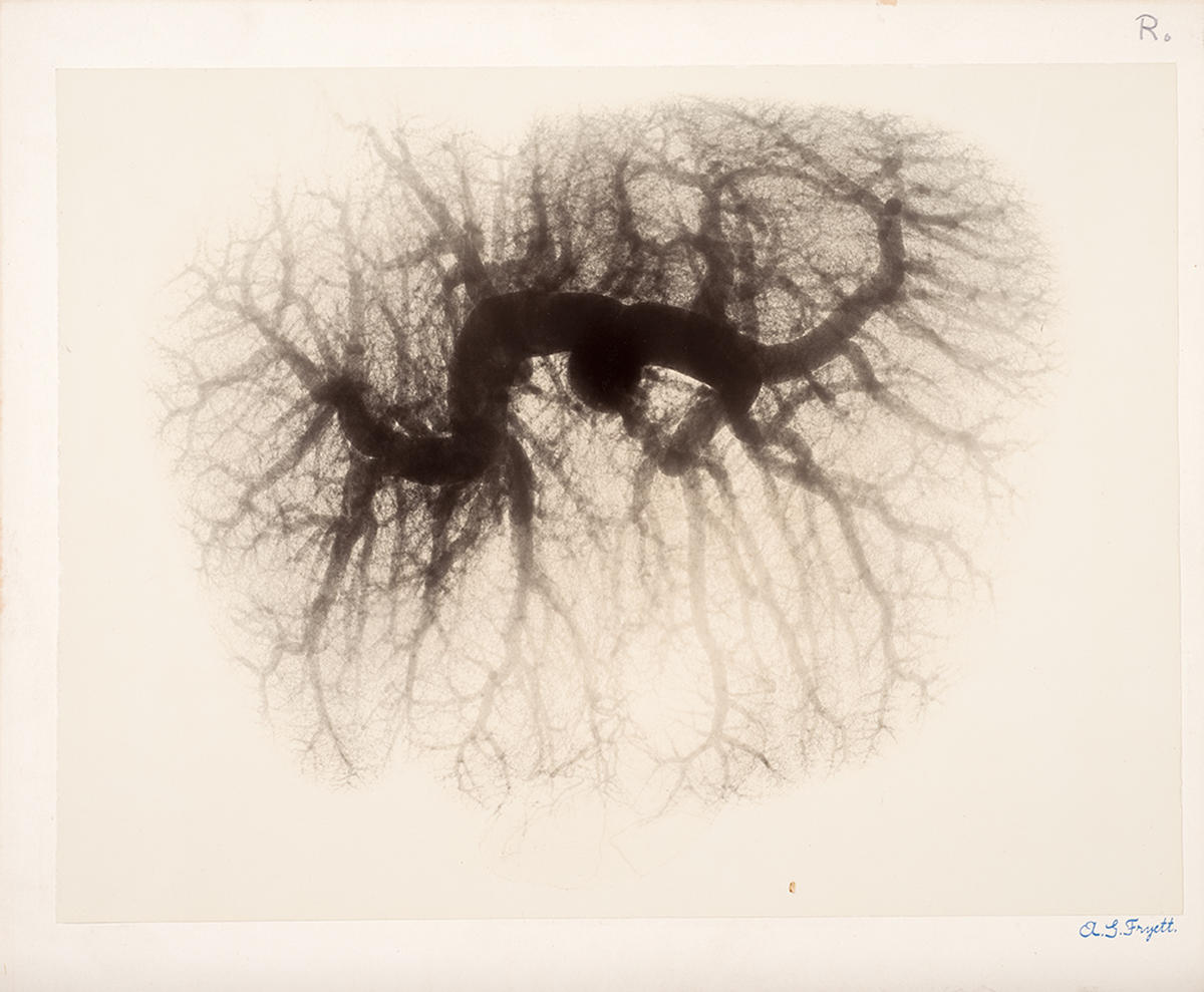 Stereo skiagram of the portal vein of the liver - Faculty of Medicine ...