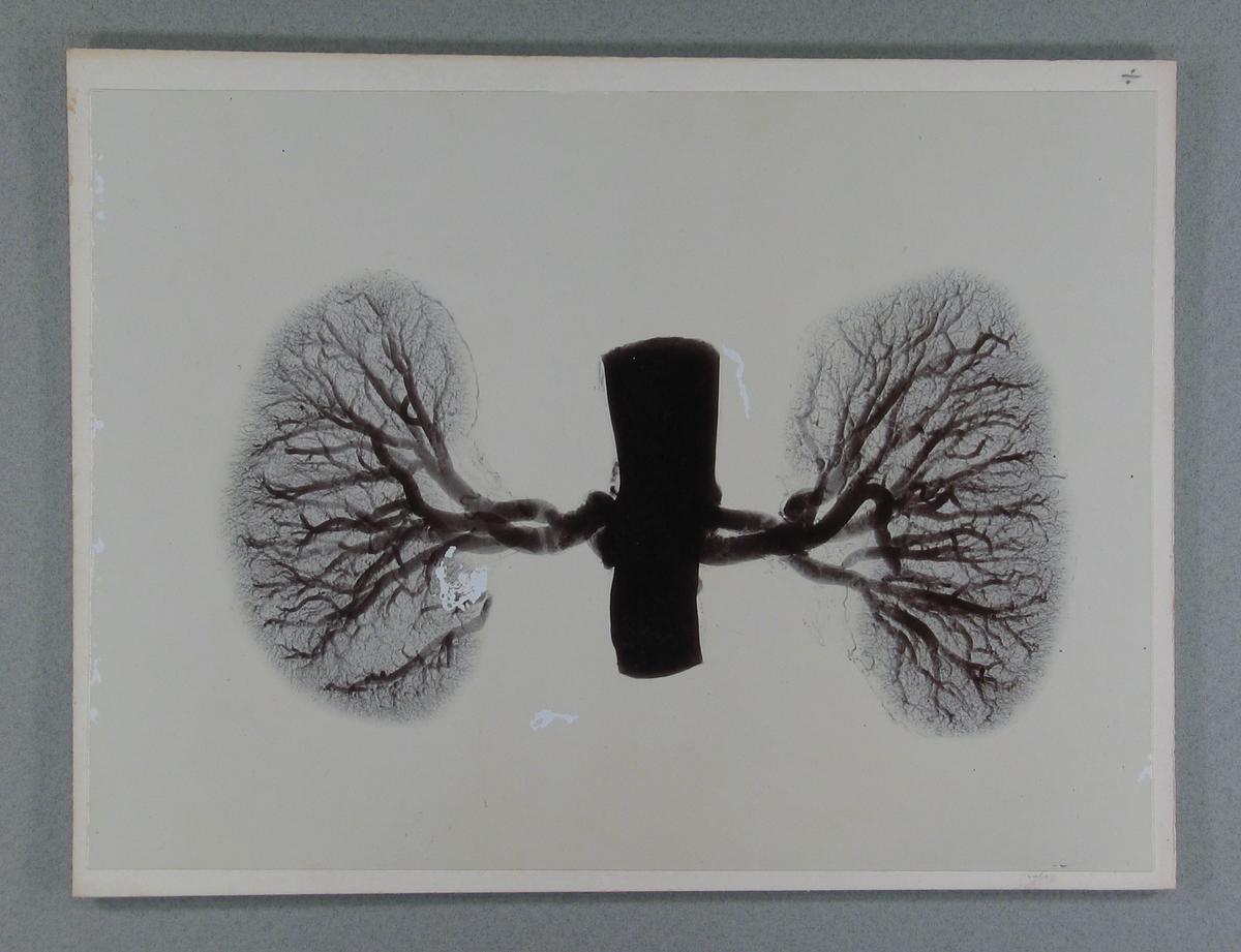 Stereo skiagram of the vessels of both kidneys - Faculty of Medicine ...