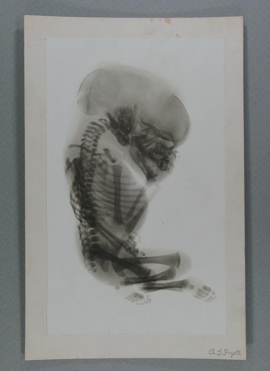 Stereo skiagram of a retained foetus in abdominal pregnancy - Faculty ...
