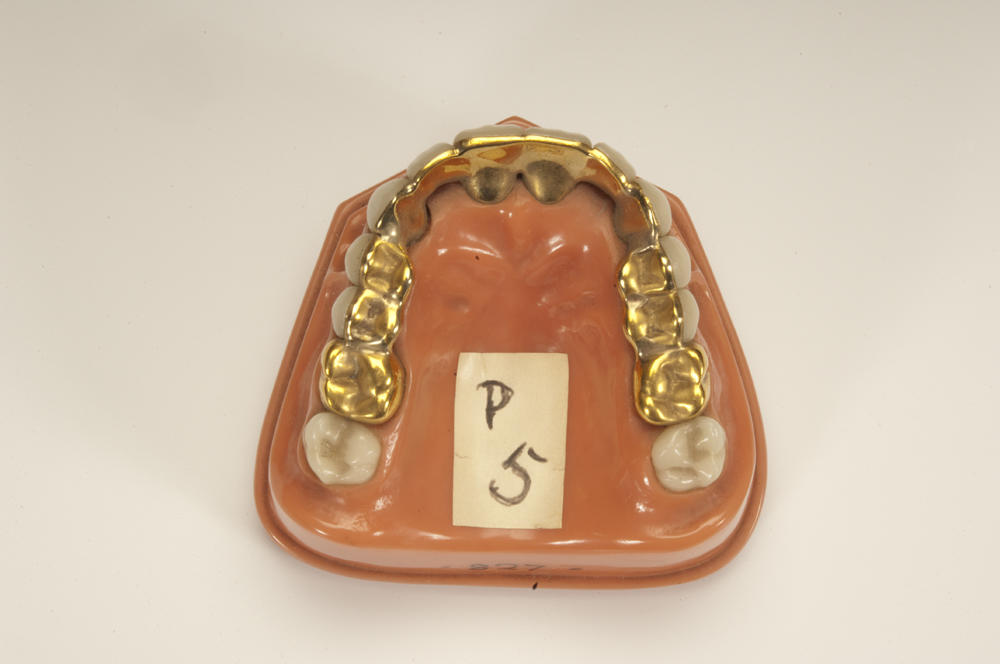 Full upper bridge - Faculty of Medicine, Dentistry and Health Sciences ...