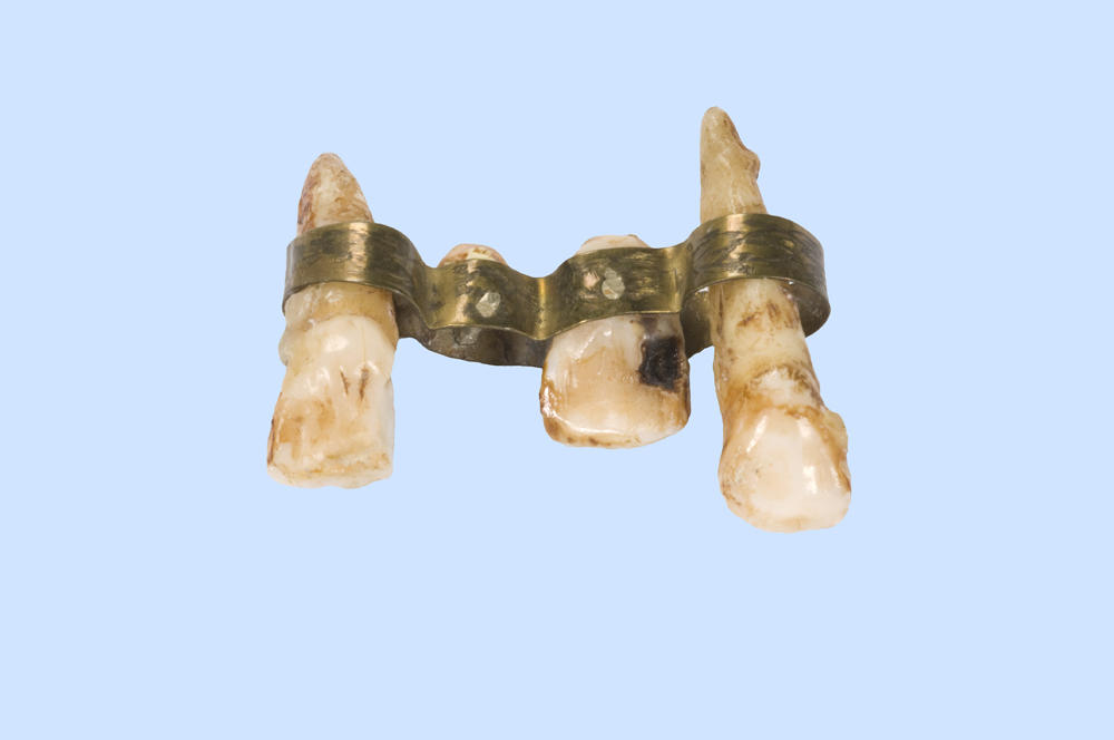 Etruscan bridge, 700-500 BCE (replica) - Faculty of Medicine, Dentistry ...