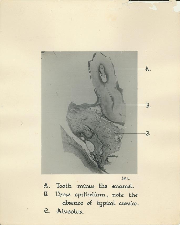 Photograph of teeth; A. Tooth minus enamel. B. Dense epithelium note ...